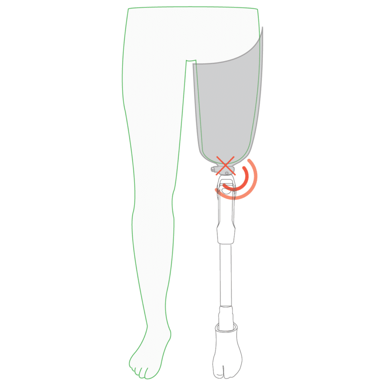 Gestion du volume du moignon | Orthoprothésistes : Bretagne - Normandie