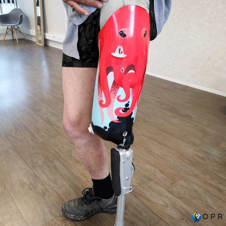 Prothèse fémorale : Fabrication et adaptation Rennes, Avranches Saint-Lô