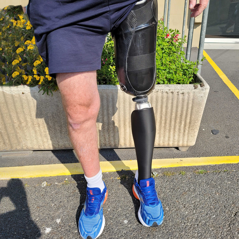 jambe-amputee-gauche-prothese-femoral | OPR : Orthèse Prothèse Rééducation